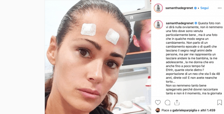 Samantha De Grenet dopo l'intervento, ha dovuto togliere quel neo ma il ...