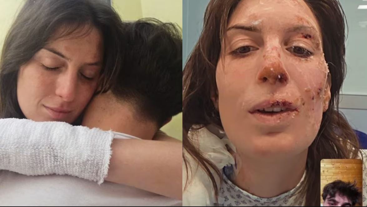Eleonora Palmieri mostra il suo volto segnato dalle ustioni dopo Crans ...